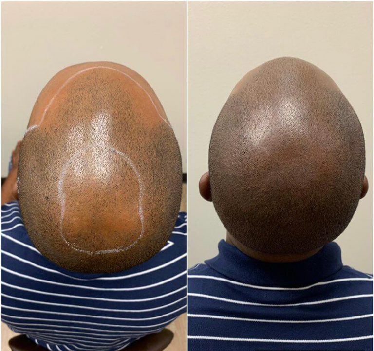 Scalp Micro Pigmentation | Micro Pigment Tattoo | The Landon Hair Clinic