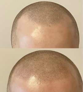 Scalp Micro Pigmentation | Micro Pigment Tattoo | The Landon Hair Clinic