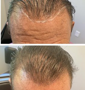 Scalp Micro Pigmentation | Micro Pigment Tattoo | The Landon Hair Clinic