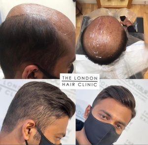 Gallery - The London Hair Clinic